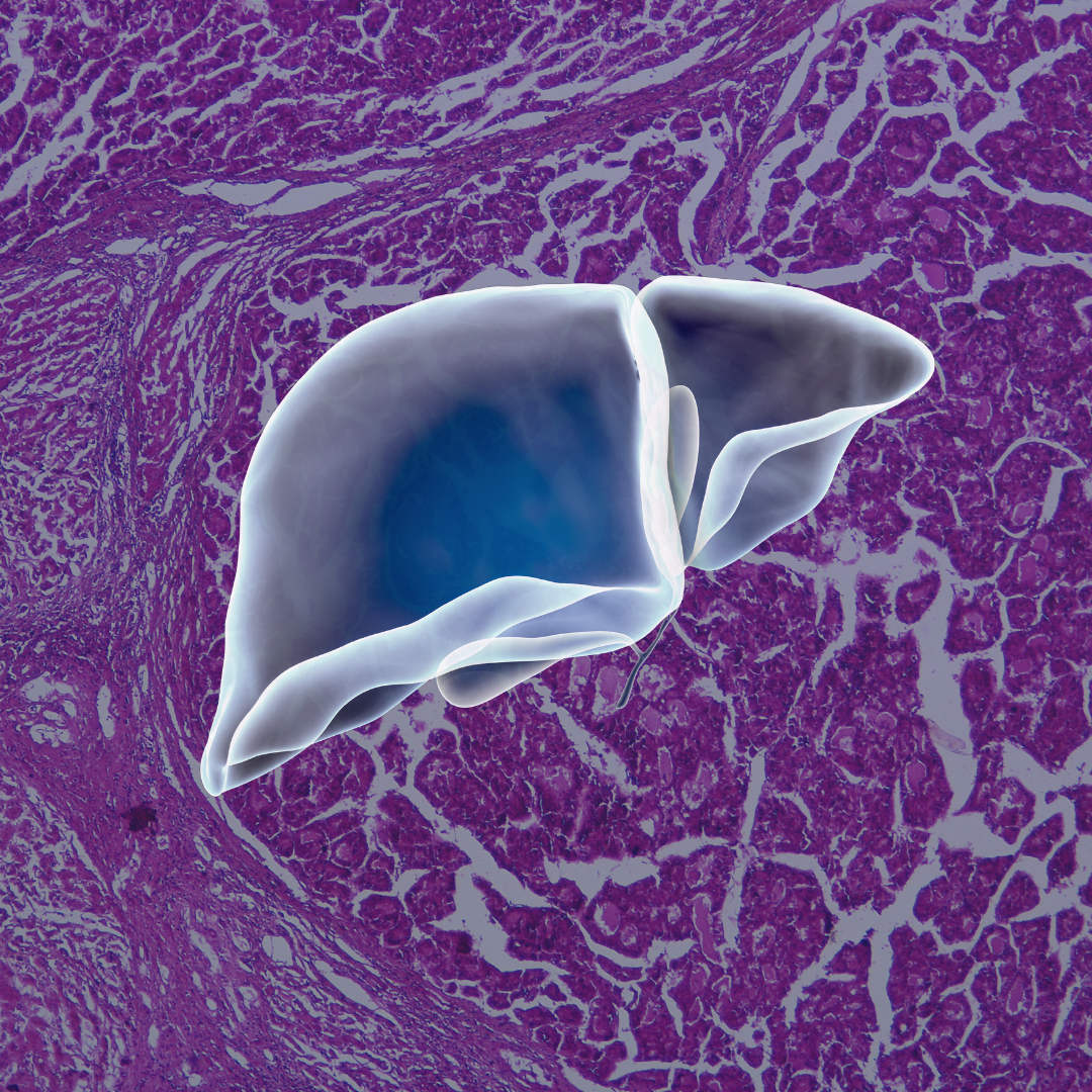 CI MED study sheds light on frequency, treatment of common liver cancer ...